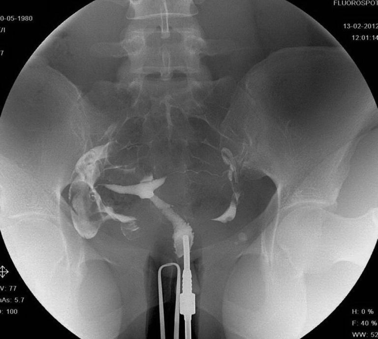 Hysterosalpingography – MSDC